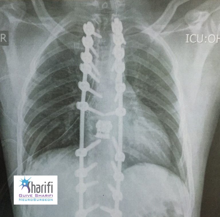 Posterior Vertebral Column Resection (PVCR) | دکتر گیو شریفی